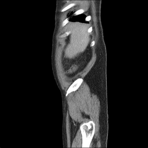 Cholangiocarcinoma Hilar Type Radiopaedia 59780 67205 C Nc Commons