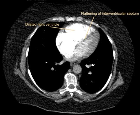 Ct Case 009 • Litfl • Ct Scan Interpretation