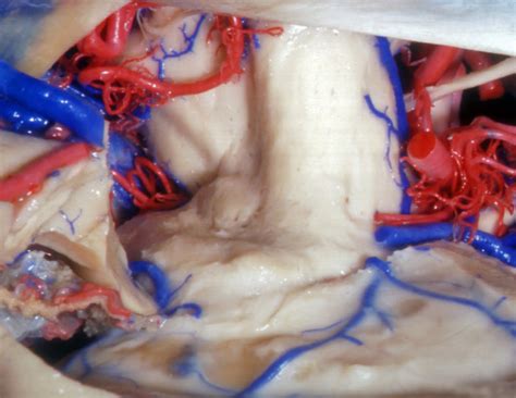 Subtemporal View Of Ambient Cistern Neuroanatomy The Neurosurgical Atlas