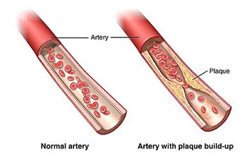 Atherosclerosis Kettering Health