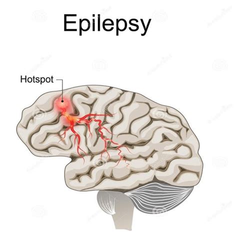 Seizures Brain