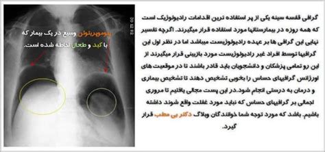 Cxr Simple But Important Ppt
