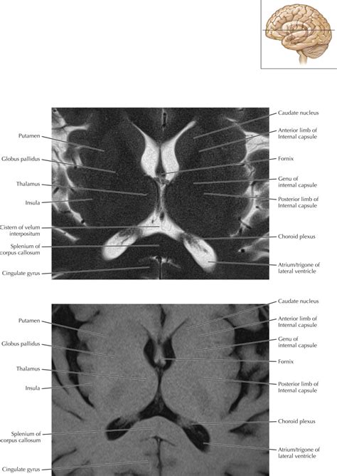 Limbic System Anatomy Mri Limbic System Anatomy Docneuro