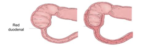Atresia Duodenal Estenosis Del Duodeno Infogen