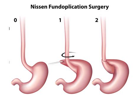 Hiatal Hernia Repair Surgery In Katy Tx Dr Clay Albrecht