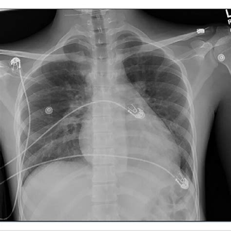 Portable Chest X Ray Showing Cardiomegaly And Mild Pulmonary Congestion