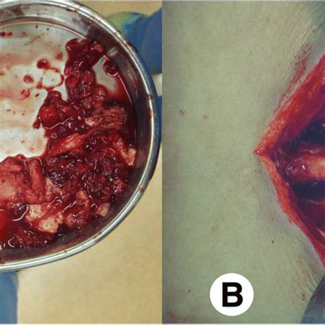 A Devitalized And Necrotic Tissue Was Extensively Resected Including