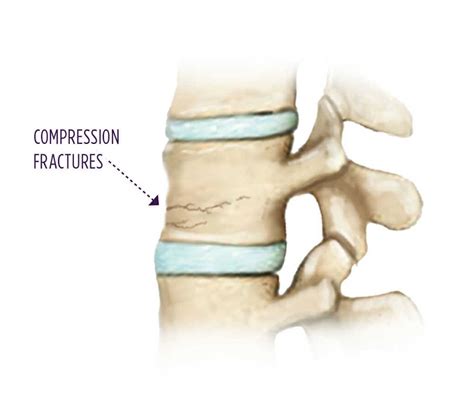 Treating Compression Fractures With Kyphoplasty Huffman Spine Clinic Huffman Clinic