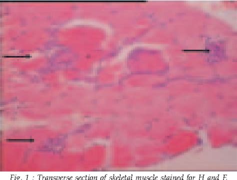 Figure 1 From Acute Myositis Semantic Scholar