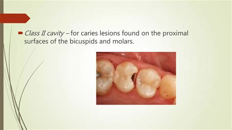 Class Ii Cavity Preparation Pptx Dental Health Diseases And Class Ii Cavity Preparation Pptx Dental Health Diseases And