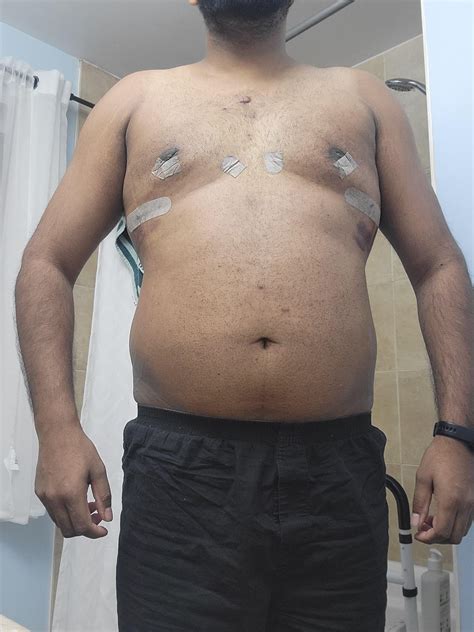 Pubertal Gynecomastia Surgery Beforeafter Rgynecomastia