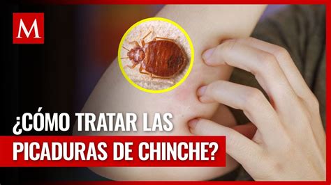 ¿te Picó Una Chinche Te Decimos Cómo Tratar La Picadura En Casa Youtube