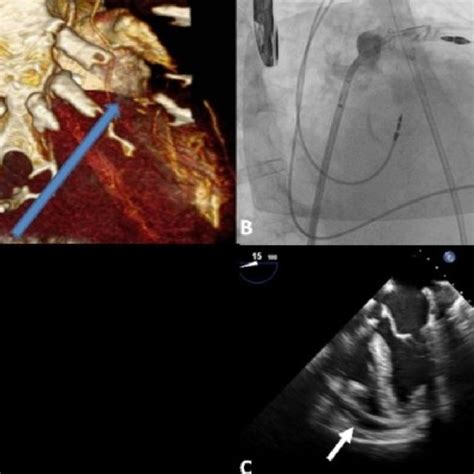A Pre Operative Appearance Of The Laa On 2d Tee B Post Operative Tee