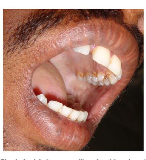 Smokeless Tobacco Lesions At Robbin Wood Blog