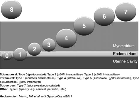 Figo Classification Of Uterine Fibroids Download Scientific Diagram