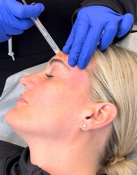 Dermal Fillers Nm Aesthetics Wellness