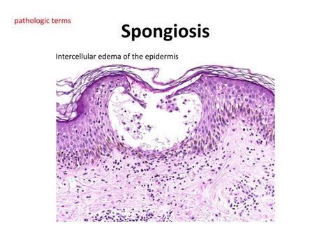 Ppt Skin Pathology Powerpoint Presentation Free Download Id1942011