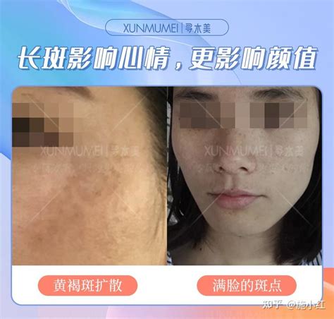 斑点的起因和祛斑方法，长斑的人一定要看看 知乎