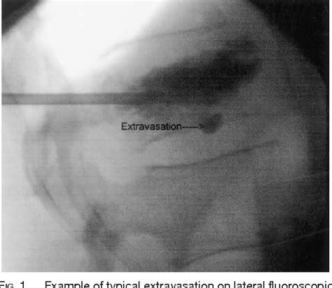 Table From New Symptomatic Vertebral Compression Fractures Within A Year Following