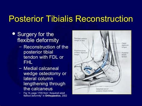 Posterior Tibial Tendon Surgery