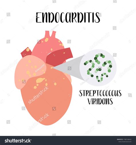 Endocarditis Inflammation Heart Endocardium Streptococcus Viridans Stock Vector Royalty Free