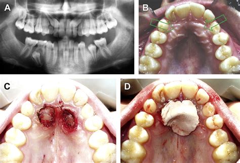 Surgical Treatment Of Impacted Canines Oral And Maxillofacial Surgery