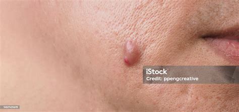 세균성 피부 감염 큰 여드름 낭종 농양 또는 궤양 얼굴 피부 조직 내의 부은 부위 고름과 혈액의 축적을 포함합니다 얼굴에 입 근처의 여드름이나 피부염의 매크로 샷 스킨케어