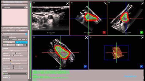 Interactive Segmentation Of Thyroid Using Imfusion Youtube