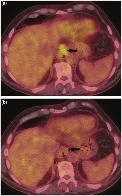 A A 70 Year Old Man With Lower Esophageal Gist Fused Fdg Pet Image