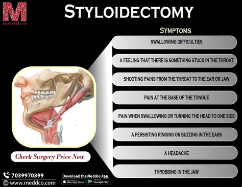Styloidectomy Eagle Syndrome