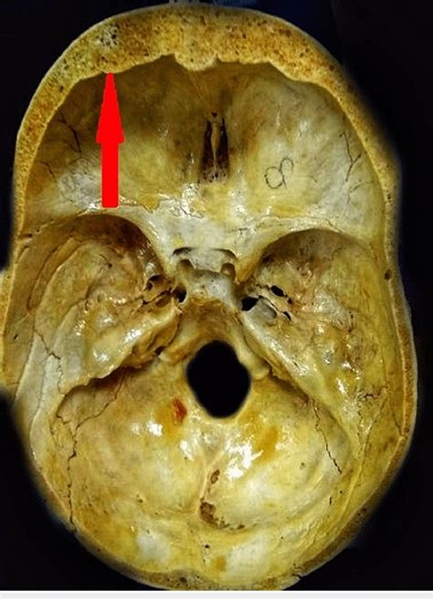 Frontal Bone Development Of Skull Neet Pg Anatomy