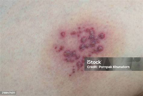 Herpes Zoster Virus Rash On Skin Showing Red Blistering Lesions In A