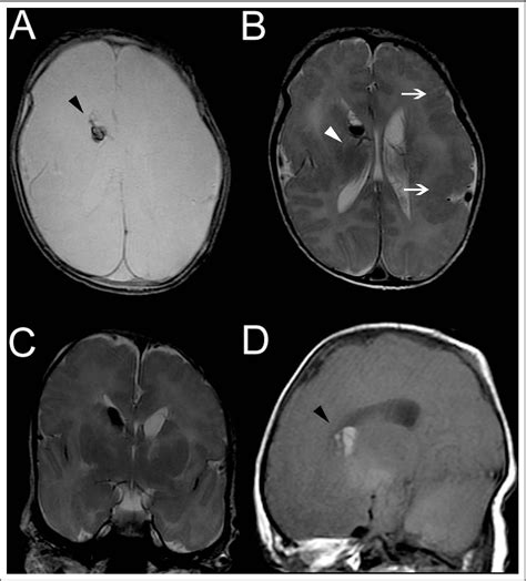 Germinal Matrix Hemorrhage Mri