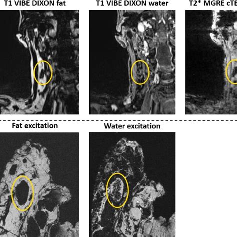 Visualization Of An On Imaging Potentially Metastatic Lymph Node Pmln