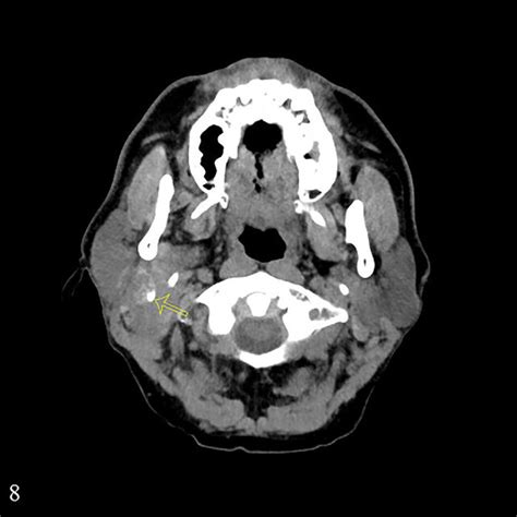 Ct Revealed Marginal Calcification Around The Nodule Within The Tumor Download Scientific