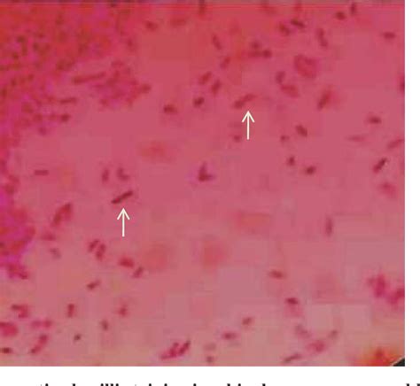 Figure 1 From Case Report The Great Mimicker “ Burkholderia Cepacia ” A Case Of Intra Abdominal