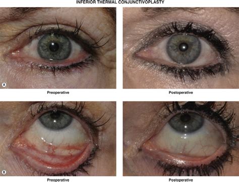 Thermal Conjunctivoplasty Plastic Surgery Key