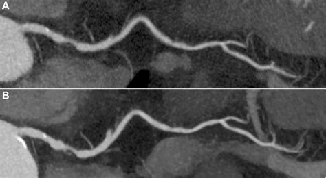Figure 3 From Iterative Reconstruction In Cardiac Ct Semantic Scholar