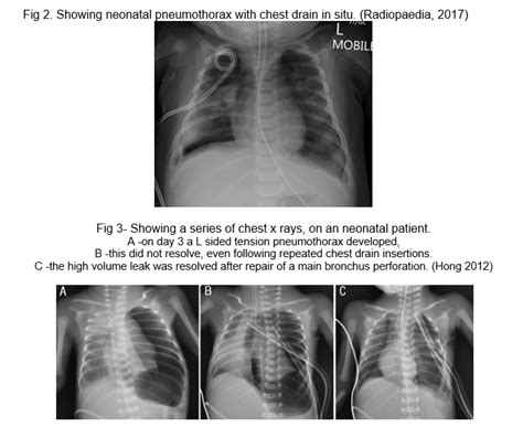 Pneumothorax Chest X Ray Labelled