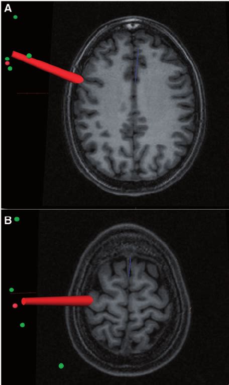 Localization On Mri Scans Of The Left Ventral Premotor Cortex A And