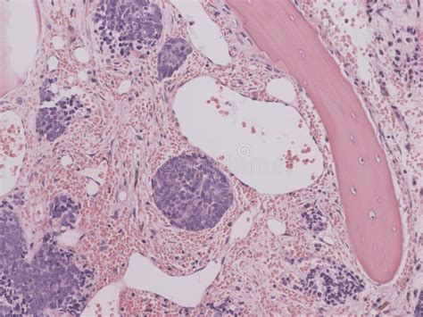 Lung Cancer Metastasis In Bone Marrow Stock Image Image Of Pathology