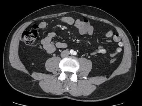 Male Pelvic Ct 2 Diagram Quizlet