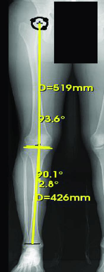 Hkaa Hip Knee Ankle Angle Mpta Medial Proximal Tibial Angle Ldfa
