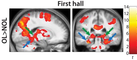 Medial Temporal Lobe Activation During The Overlapping First Hall Download Scientific Diagram