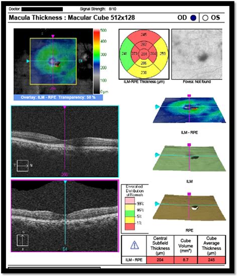 Butterfly Shaped Pattern Dystrophyan Observational Teaching Case