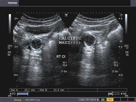 Ovarian Thecoma Ultrasound