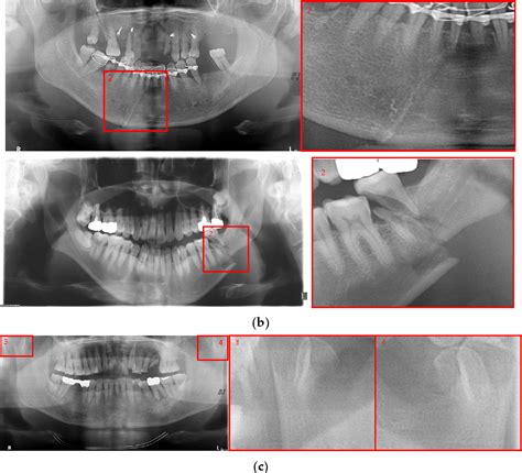 Figure 2 From Combined Deep Learning Techniques For Mandibular Fracture