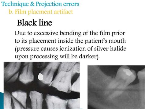 Errors Of Dental Radiography