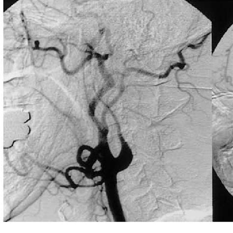 A Right Vertebral Angiogram On Admission Showing Aneurysmal Dilatation