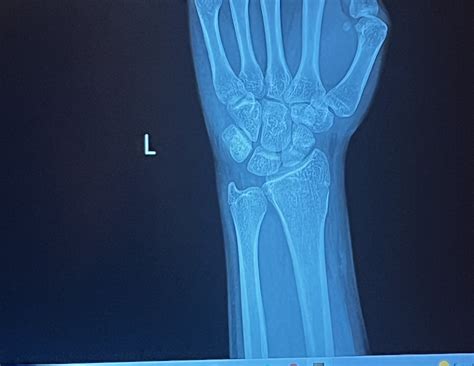 Wrist Growth Plates Xray Mens Self Improvement